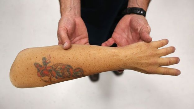 ‘I had a double hand transplant’
