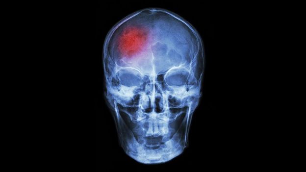 Seven steps to creating a brain implant