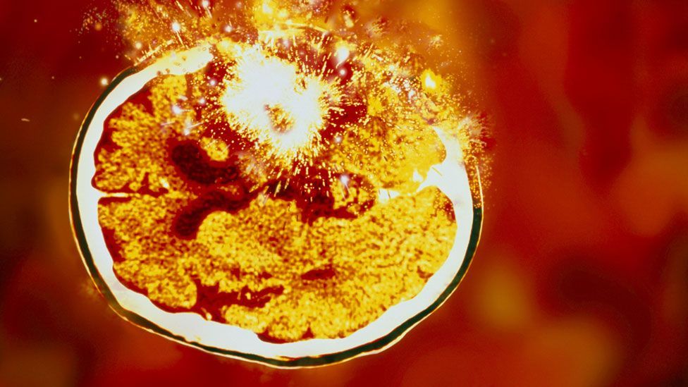 Does your head explode at night? - BBC Future