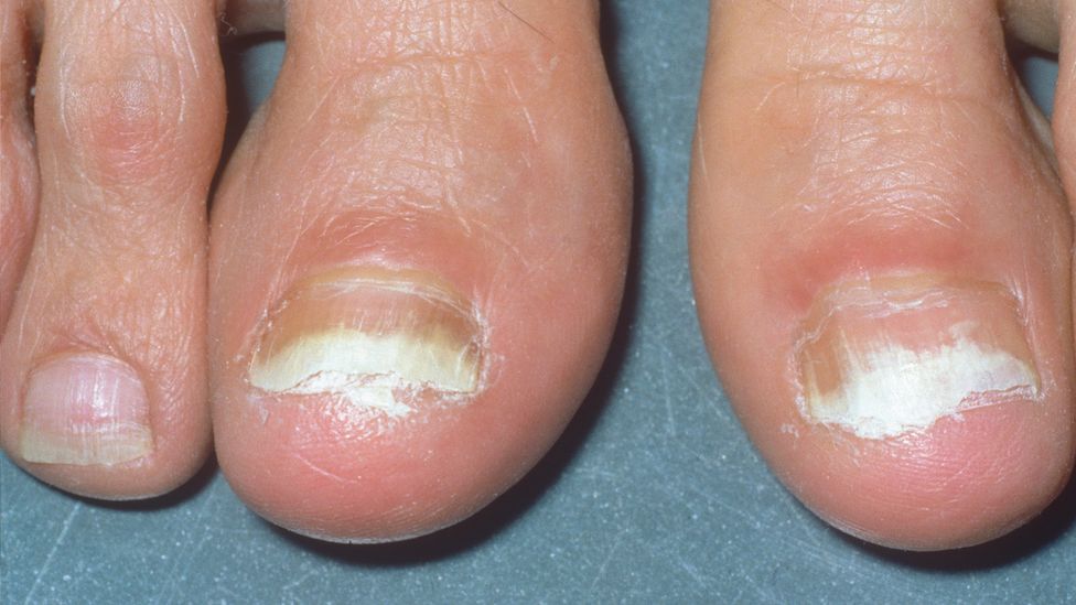 What your fingernails can reveal about your health - BBC Future